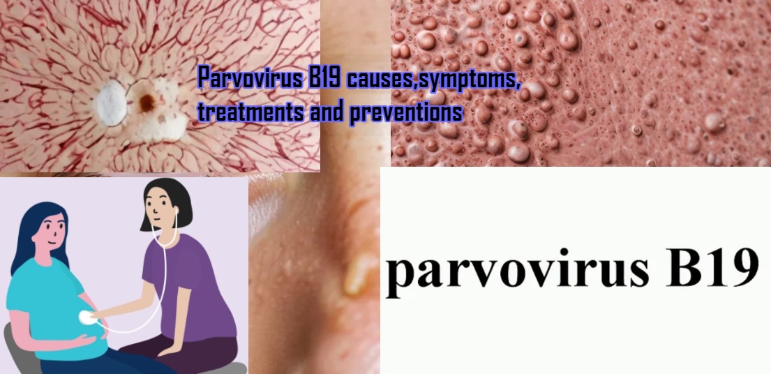Exploring the causes, symptoms, and treatment of Parvovirus B19 - sharpinn